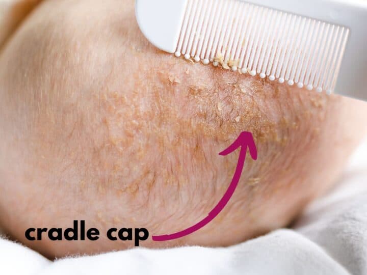 Complete guide to Cradle Cap and Baby - She's Your Friend